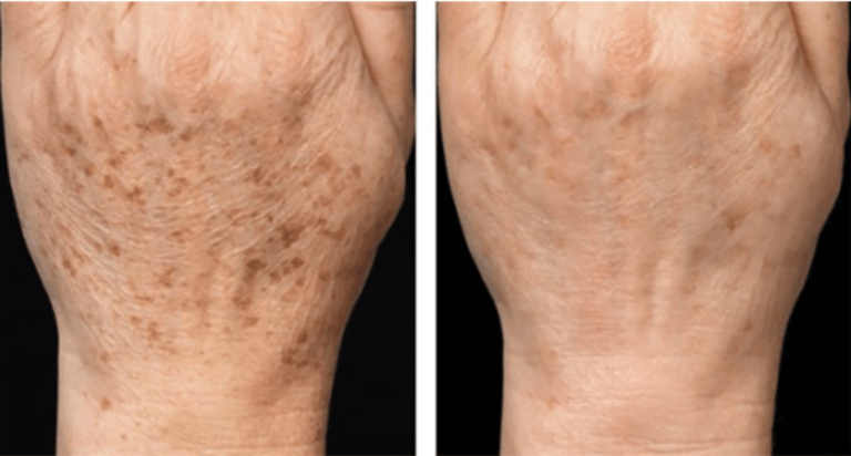 How To Fade Sun Spots And Reverse Sun Damage | Blog | HUDA BEAUTY