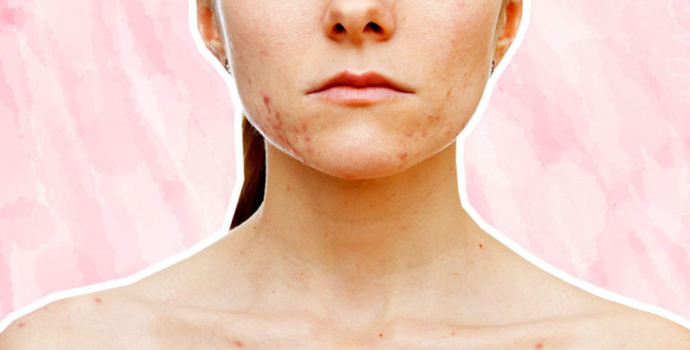 How To FINALLY Decode Your Acne & Find The Best Treatment For You ...