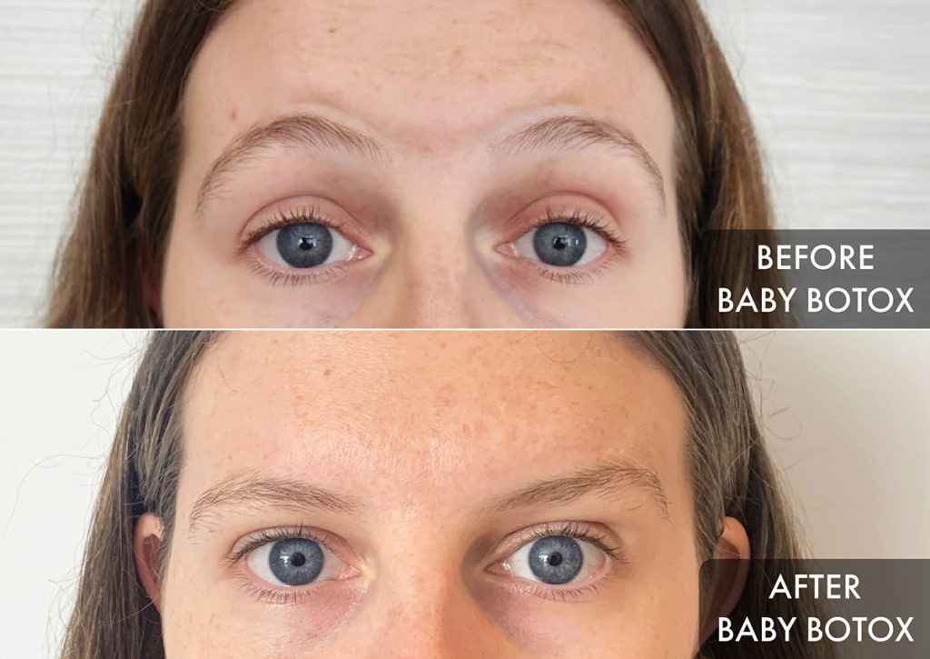 Not Sure When To Get Botox? We Tried Baby Botox For The First Time ...